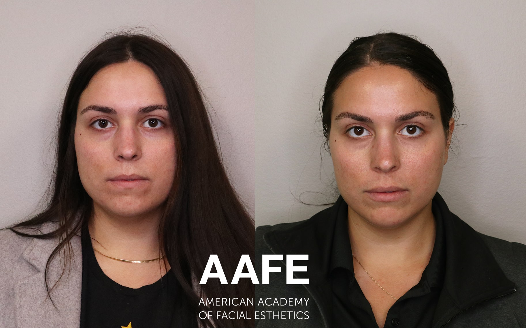 Recent Patient Treatment - AAFE - American Academy of Facial Esthetics Blog