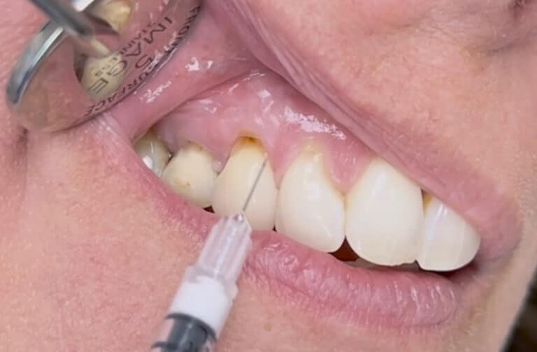 Gum Builder & Filler Training - Black Triangle | AAFE